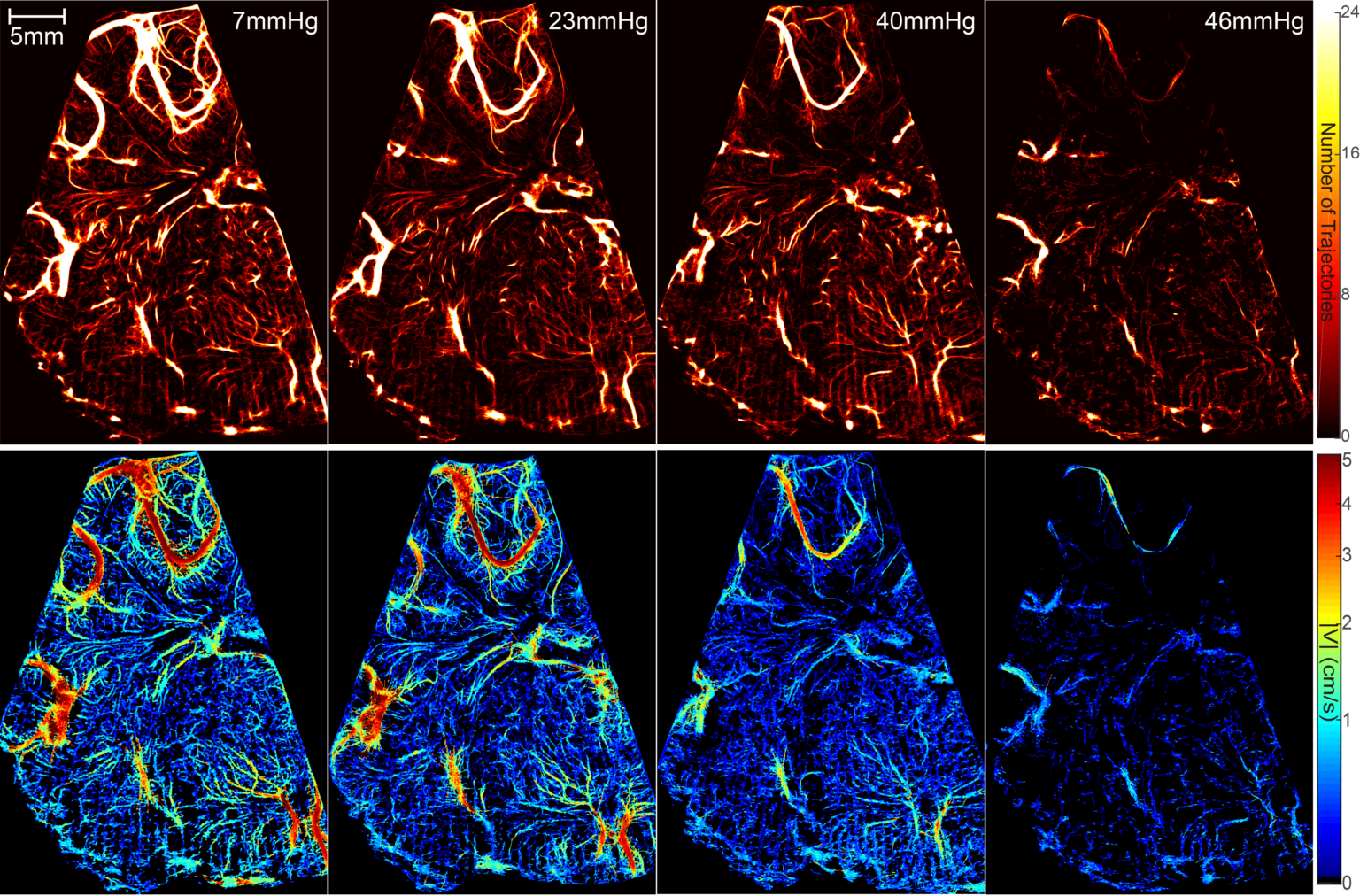 Cerebral Microcirculation in Infantile Hydrocephalus - Laboratory for ...