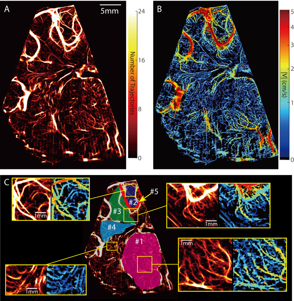 Cerebral Microcirculation in Infantile Hydrocephalus - Laboratory for ...