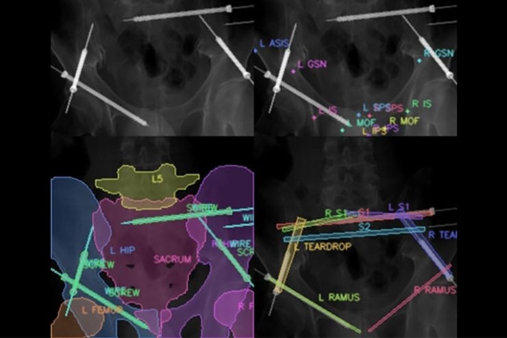 X-ray Vision: Tech Could Improve Efficiency of Pelvic Fracture Surgery ...