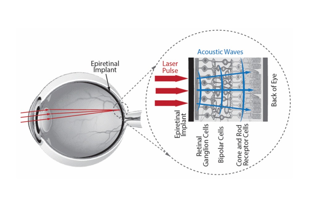 New Nanomaterial for Retinal Implants Could Someday Help Restore Sight ...